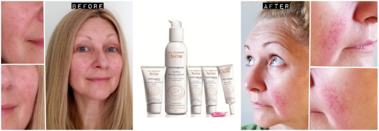 Rosacea Reviews: Avene Antirougeurs & La Roche-Posay Rosaliac